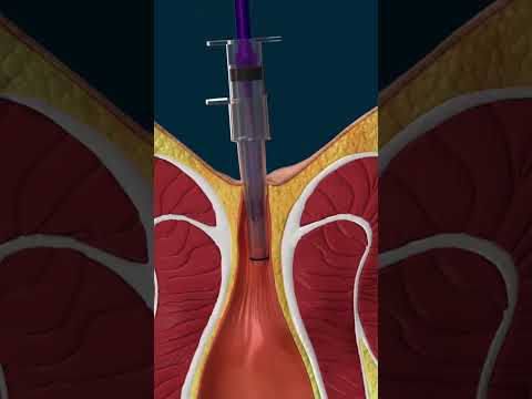 Hemorrhoids Surgery #shorts