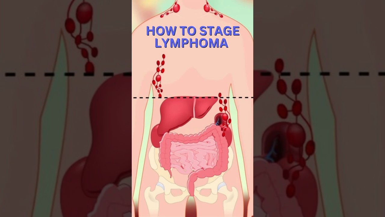 What is LYMPHOMA & How to Stage it!