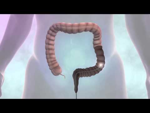 Testing for Bowel Cancer | Cancer Research UK