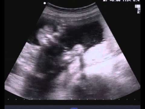 micrognazia ecografia ostetrica morfologica strutturale | Il sorriso di ...