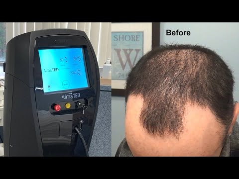 MY FIRST ALMA TED HAIR RESTORATION TREATMENT (NON INVASIVE HAIR REGROWTH USING ULTRASOUND WAVES)