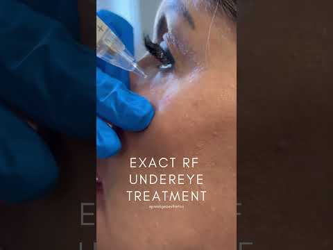 Exact RF Under-eye Treatment!