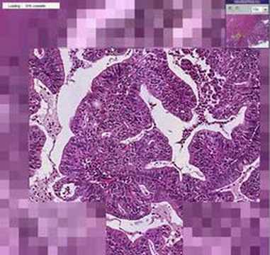 Histopathology Uterus--Endometrial adenocarcinoma