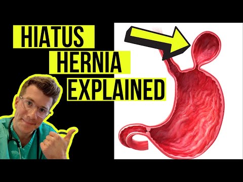 Everything you need to know about a HIATUS HERNIA | Causes, symptoms, diagnosis & treatment