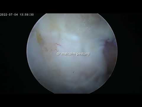 cervical laminectomy and big foraminotomy c4/5 c5/6 c6/7