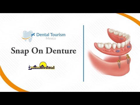 Snap On Denture Nogales - Dental Tourism Mexico