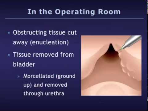 Holmium Laser Enucleation of the Prostate HoLEP for Benign Prostatic Hyperplasia BPH
