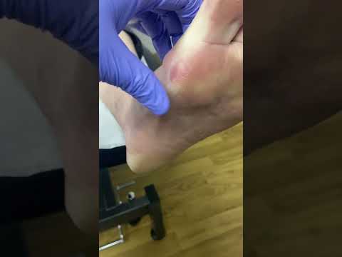 Watch how an Aussie podiatrist tackles dry, cracked bunions! #FootHealth #BunionRelief