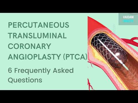 Percutaneous Transluminal Coronary Angioplasty- 6 Frequently Asked Questions.