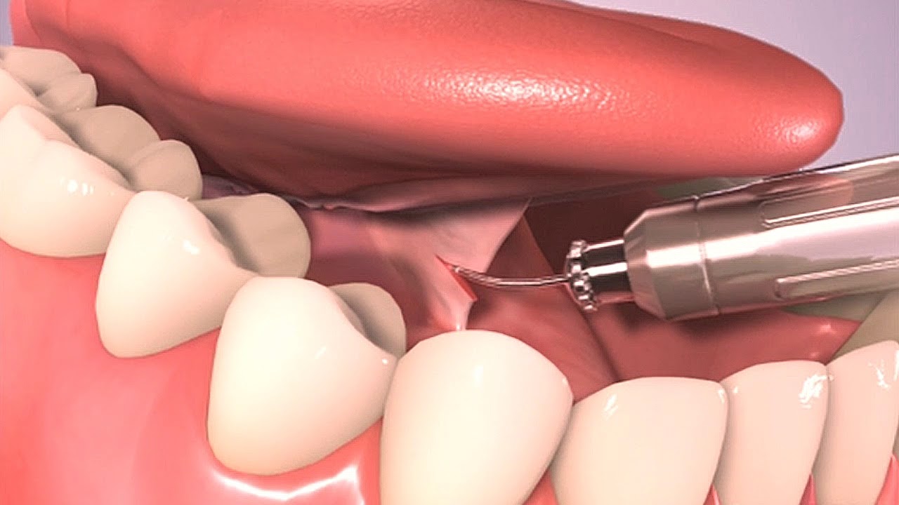 Laser Frenectomy