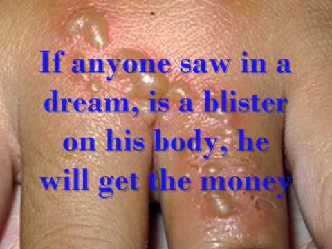 خواب میں آبلہ دیکھنا - Blisters on the hands or body in dream