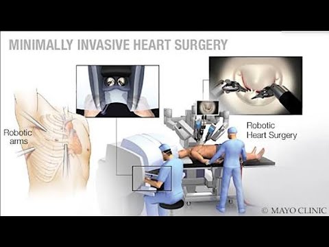 Robotic CABG