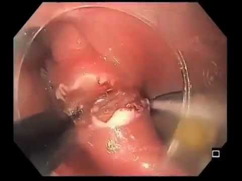 New Therapeutic Endoscopic Techniques