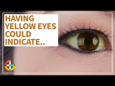 [Health Talk] Causes and Conditions of Yellow Eyes