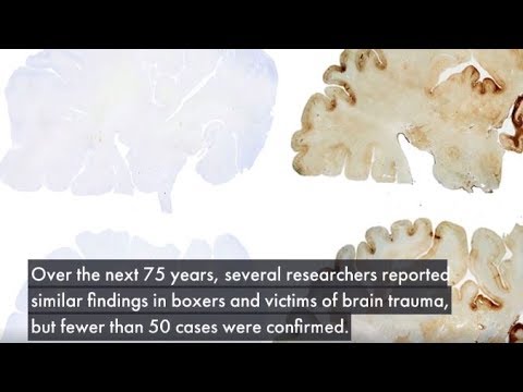 A Brief History of Chronic Traumatic Encephalopathy (CTE)