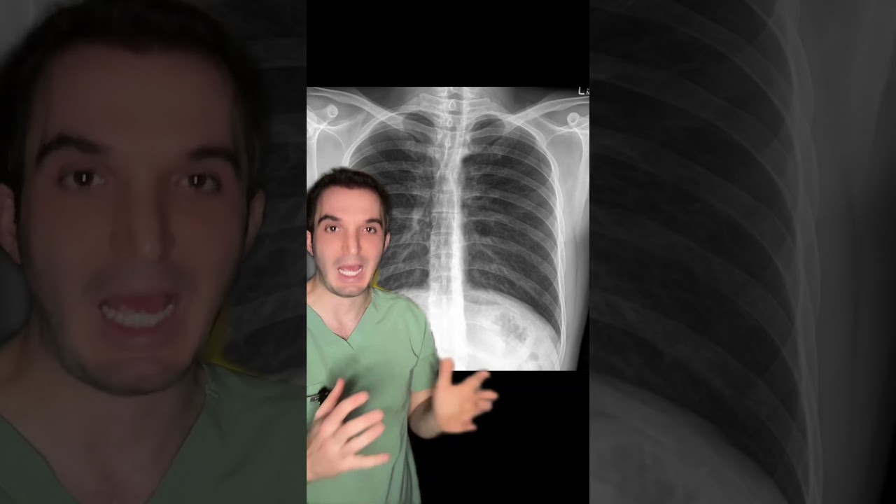 Radiologist versus AI: diagnosing brain bleed and Tin Man Syndrome myself versus ChatGPT and Grok