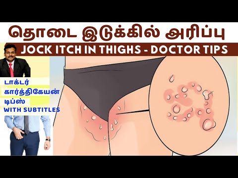 தொடை இடுக்கில் அரிப்பு நீங்க | jock itch dark skin spots black patches removal home remedies karthik
