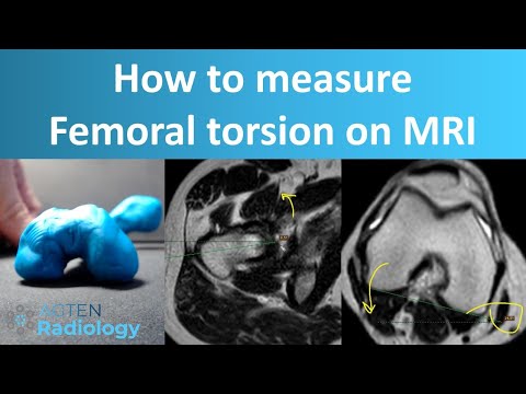 How to Measure Femoral Torsion on MRI