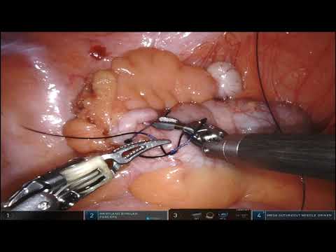 Robotic Appendectomy HD 720p