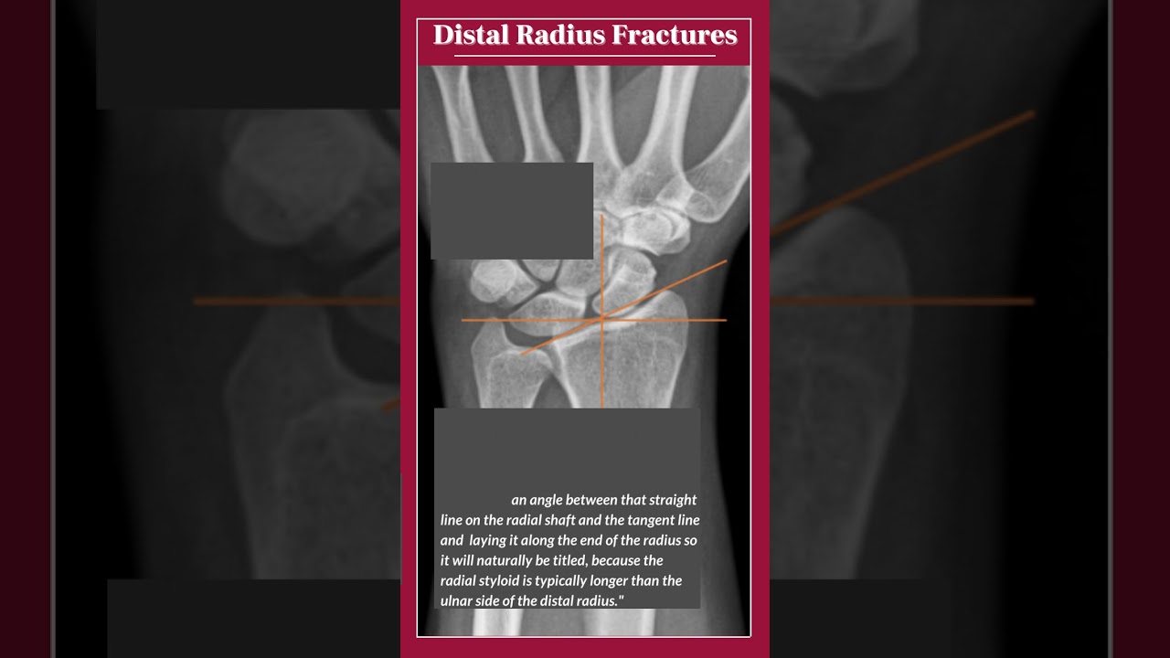 Out Now on the orthoPAc podcast! Distal Radius Fractures | Sam Dyer, PA-C, MHS