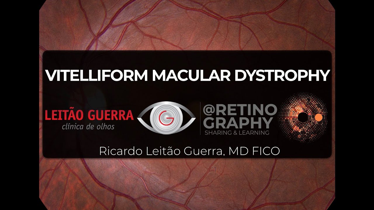 Vitelliform macular distrophy - Multimodal retinal imaging analysis