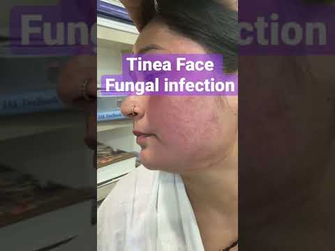 Fungal infection #indore #dermatologist #skincare #infection #fungus
