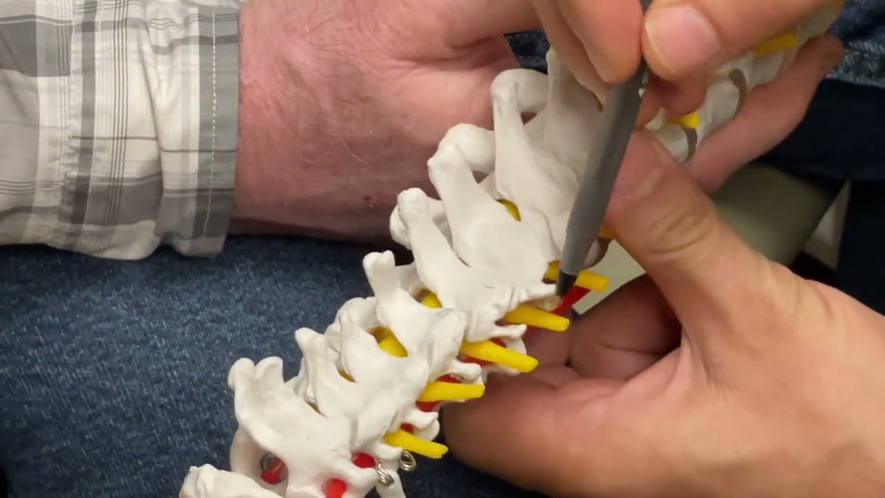 IMG 9090  Posterior cervical decomportession and fusion explanmed