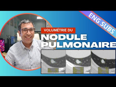[ENG subs] Bigger or not? How to evaluate lung nodule using chest CT and volumetric analysis