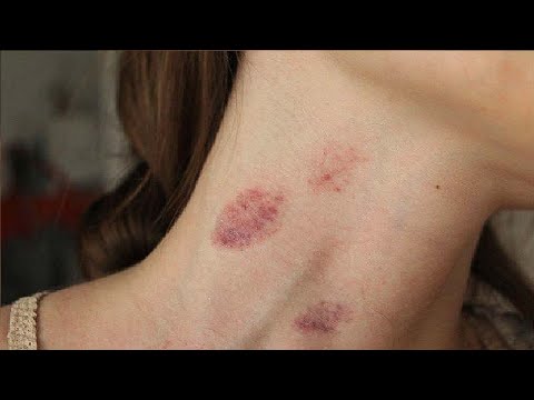 how to give a love bite on the neck easy