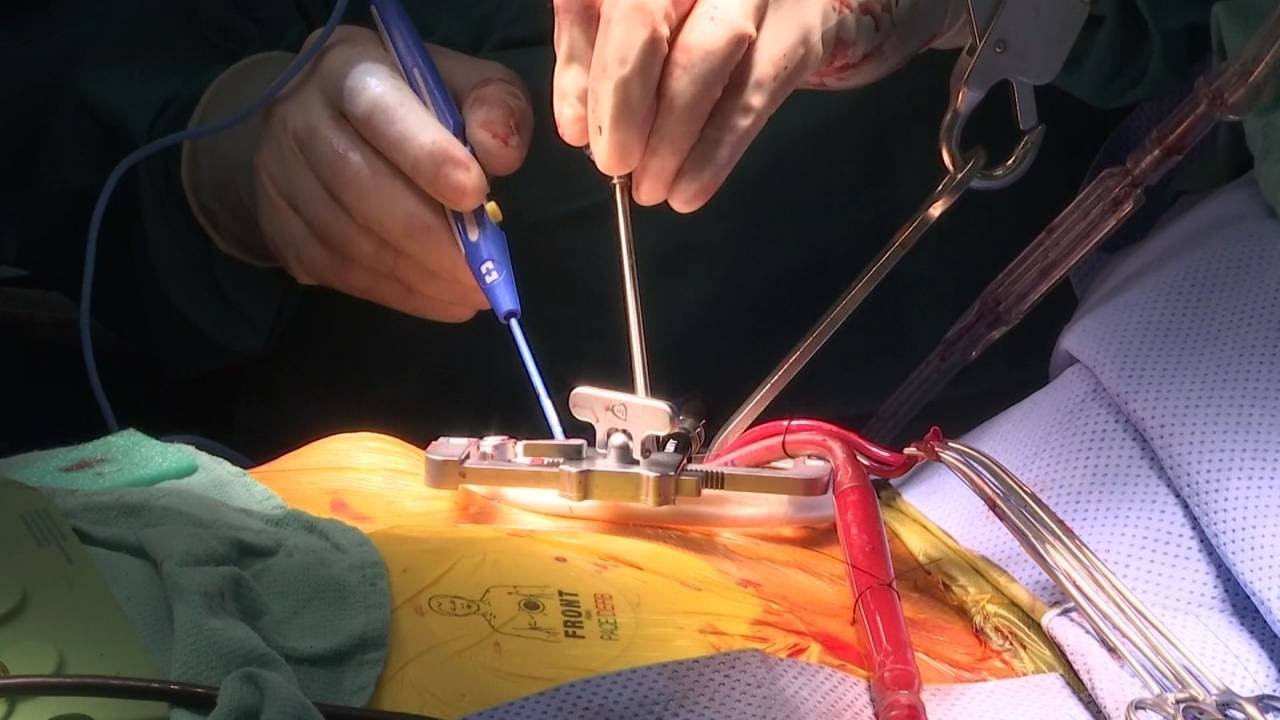 How minimally invasive heart surgery is changing lives