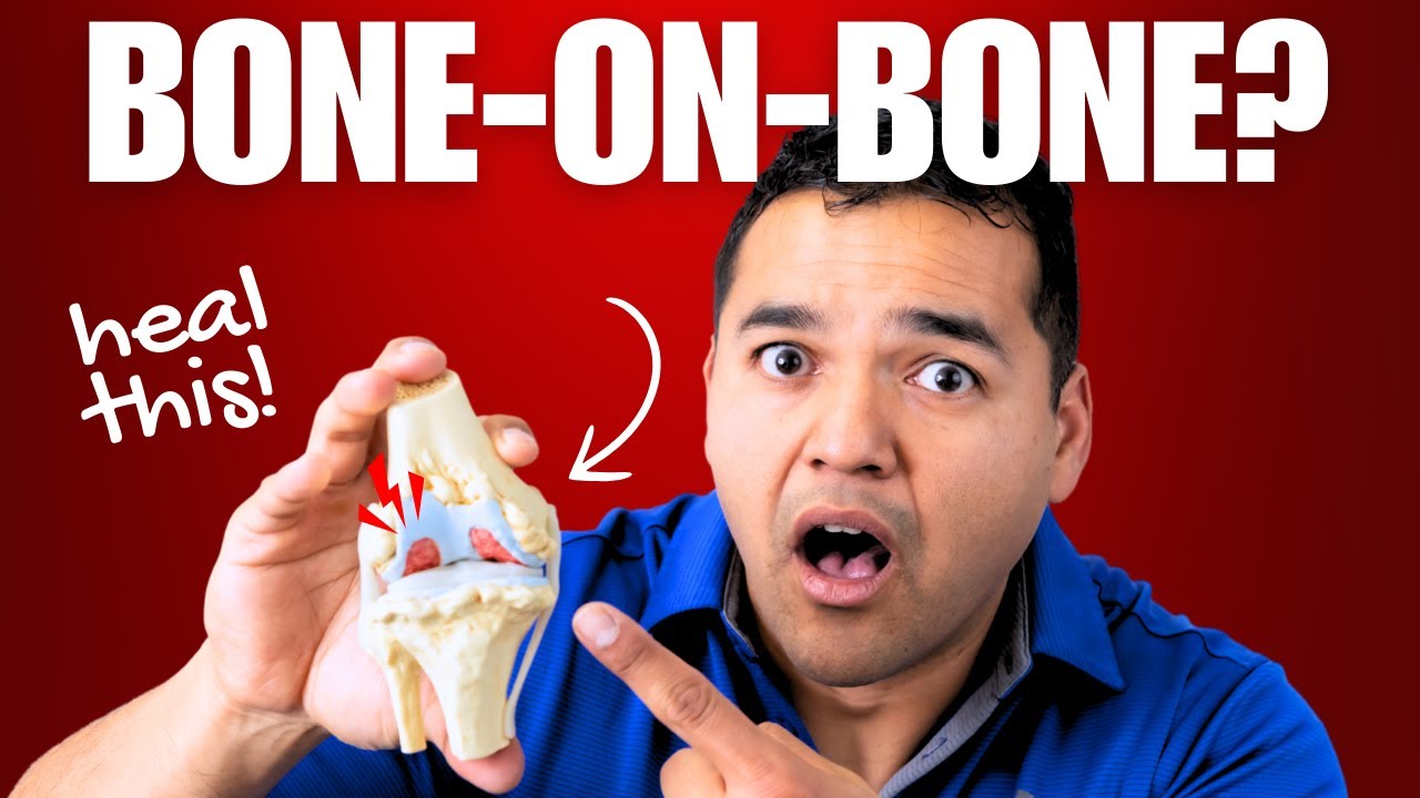 Understanding and Healing Bone-on-Bone Knee Arthritis: Four Key ...