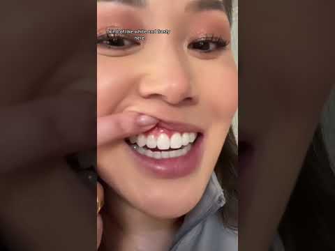 I accidentally burned my gums with teeth whitening chemicals. #teethwhitening #whiteteeth #dentist