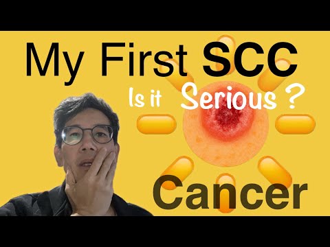 My First Squamous Skin Cancer SCC Diagnosis - Is it Serious?