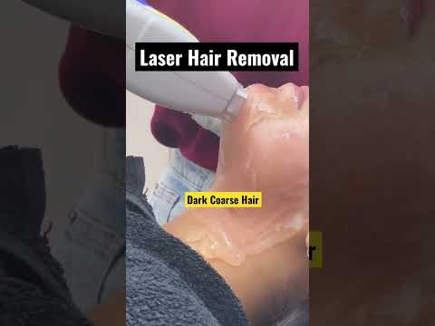Laser Hair Removal face| Laser for hair removal| Laser hair reduction in Delhi