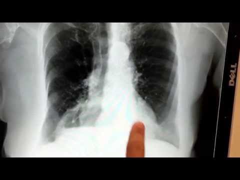 Severe PNA on X-ray