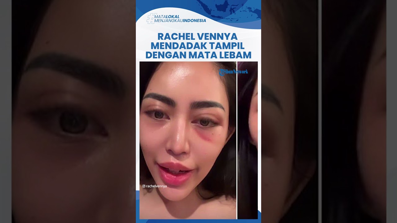 Rachel Vennya Tampil dengan Mata Lebam Buat Netizen Bertanya-tanya ...