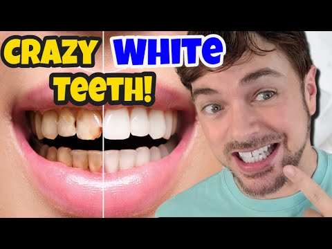 Get CRAZY WHITE Teeth! | Best Teeth Whitening Products That Work | Chris Gibson