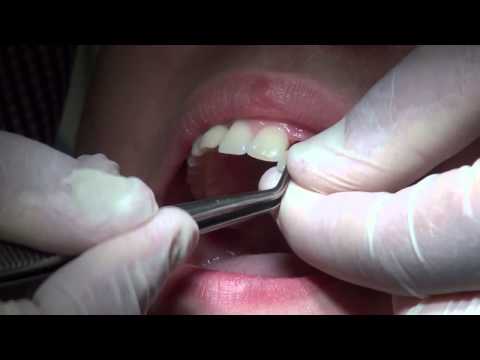 Zahn OP - Dr. Blum - Keystone Implantat - pt.3
