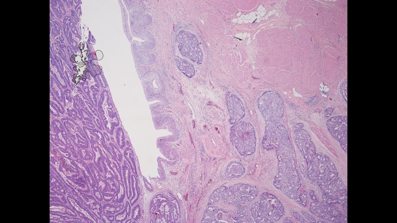 Urachal Tumours - Pathology mini tutorial