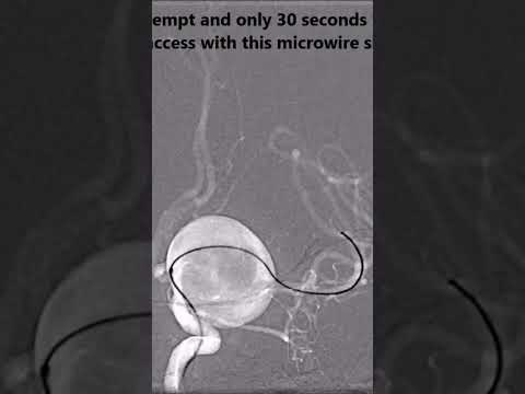 Crossing a Giant Brain Aneurysm with Microwire #shorts