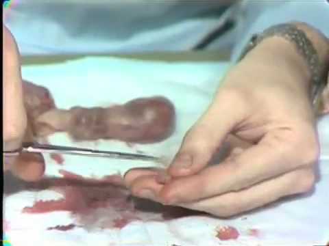 Dissection of Acellular Basement Membrane