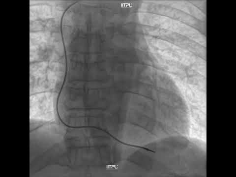 Pacemaker Implantation