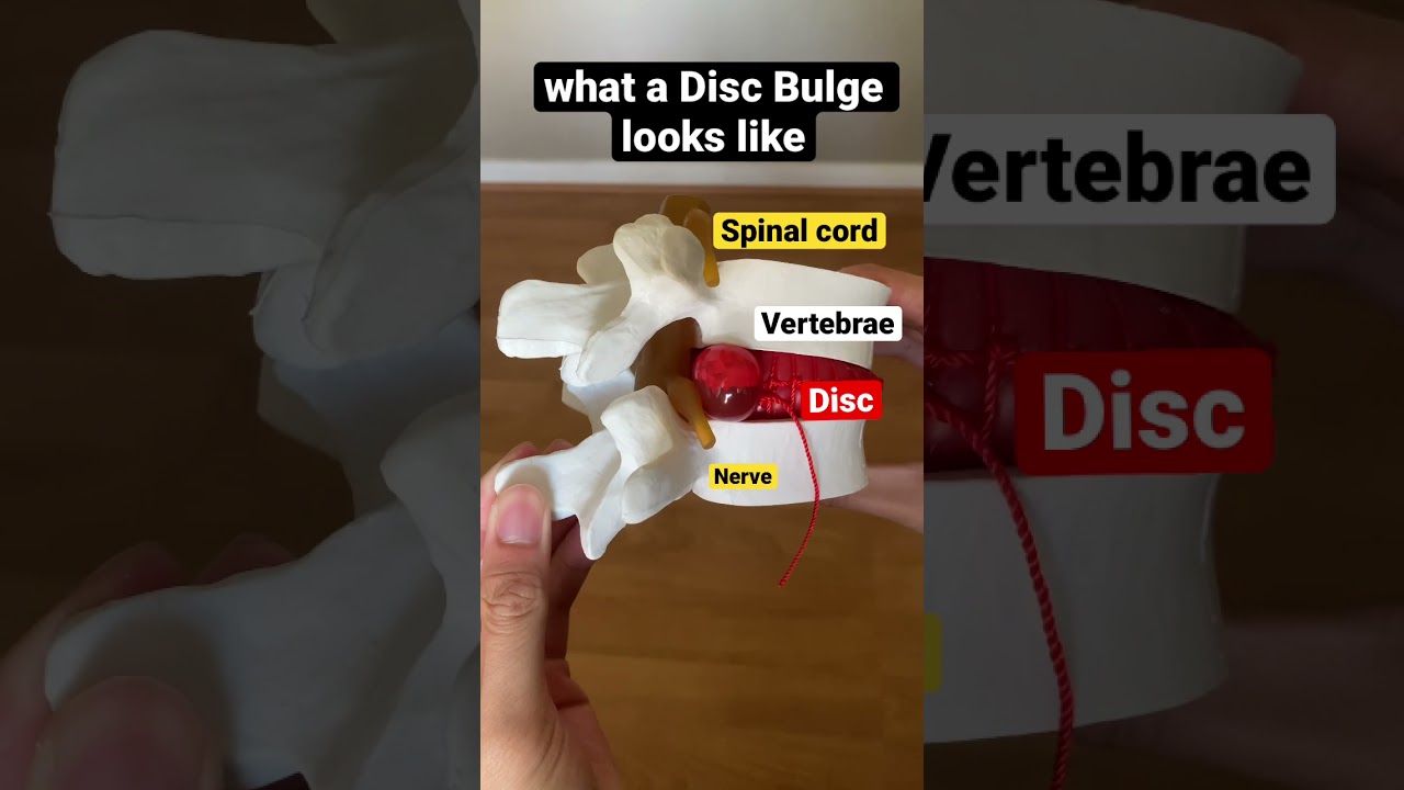what a Disc Bulge looks like 😲