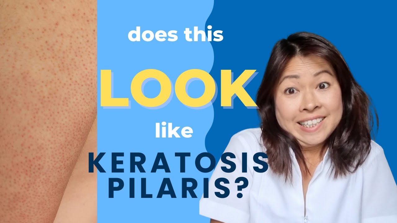 Does this look like keratosis pilaris (KP)?