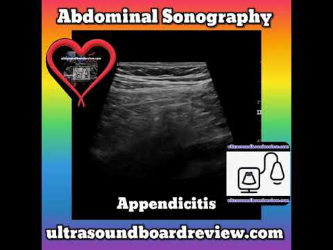 Appendicitis