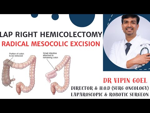 Laparoscopic Right Radical Hemicolectomy With Complete Mesocolic Excision • Video • MEDtube.net