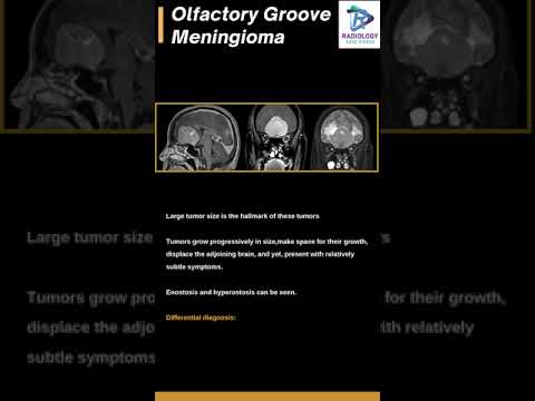 Olfactory groove meningioma#Meningioma#Extra-axial tumor.