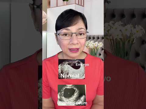 Ano ang BLIGHTED OVUM? Vlog 173