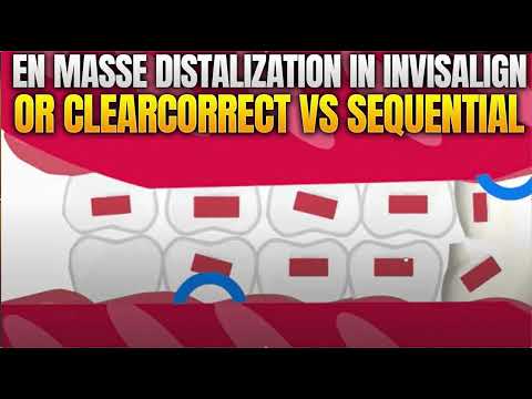 En Masse vs Sequential Distalization in ClearCorrect or Invisalign