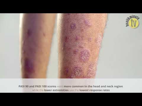 Ustekinumab less effective for psoriasis in lower extremities, according to study